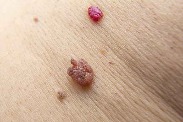 Cherry Angioma Removal Treatment Wakefield Book In Now